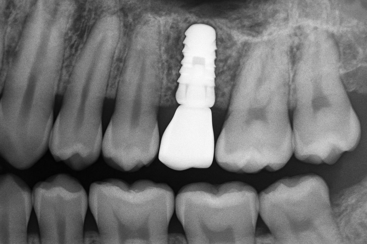 Tooth Implant Recovery: What To Expect From MoArk Dental | MoArk Dental ...